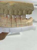 China Full Zirconia Dental Crown - Biocompatible High Strength Zirconia Dental Restoration for sale
