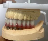 China Full Zirconia Dental Crown with Abutment - Biocompatible and High Strength Zirconia Material for sale