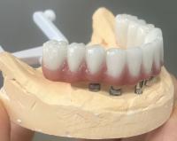 China Full Zirconia Dental Crown with Abutment - Biocompatible and High Strength Zirconia Material for sale
