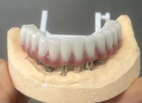 China Full Zirconia Dental Crown with Abutment - Biocompatible and High Strength Zirconia Material for sale