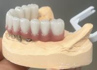China Full Zirconia Dental Crown with Abutment - Biocompatible and High Strength Zirconia Material for sale