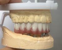 China Full Zirconia Dental Crown with Abutment - Biocompatible and High Strength Zirconia Material for sale