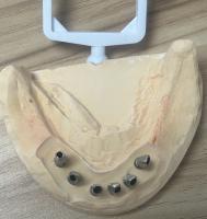 China Full Zirconia Dental Crown with Abutment - Biocompatible and High Strength Zirconia Material for sale