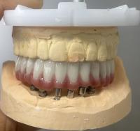 China Full Zirconia Dental Crown with Abutment - Biocompatible and High Strength Zirconia Material for sale