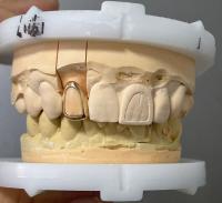 China Gold Open Window Crown for sale