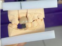 China Full Zirconia Crown with 1200 MPa Strength, High Aesthetic Translucency, and CAD/CAM Precision Milling for Dental Restoration for sale