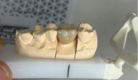 China Full Zirconia Crown with 1200 MPa Strength, High Aesthetic Translucency, and CAD/CAM Precision Milling for Dental Restoration for sale