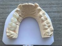 China Full Zirconia Crown with 1200 MPa Strength, High Aesthetic Translucency, and CAD/CAM Precision Milling for Dental Restoration for sale