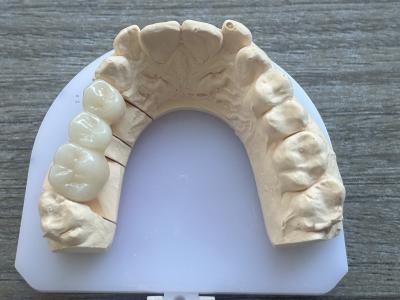 China Full Zirconia Crown with 1200 MPa Strength, High Aesthetic Translucency, and CAD/CAM Precision Milling for Dental Restoration for sale