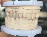China Full Zirconia Crown with 1200 MPa Strength, High Aesthetic Translucency, and CAD/CAM Precision Milling for Dental Restoration for sale