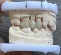 China Full Zirconia Crown with 1200 MPa Strength, High Aesthetic Translucency, and CAD/CAM Precision Milling for Dental Restoration for sale