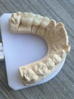 China Full Zirconia Crown with 1200 MPa Strength, High Aesthetic Translucency, and CAD/CAM Precision Milling for Dental Restoration for sale