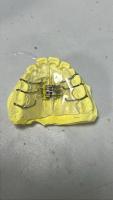China Customized Orthodontic Appliances and Dental Aligners with Digital Design and Medical-Grade Thermoplastic for sale
