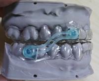 China Custom Anti-Snoring Device - Medical-Grade Thermoplastic Mandibular Advancement Device for Snoring and Sleep Apnea for sale