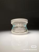 China Custom Anti-Snoring Device - Medical-Grade Thermoplastic Mandibular Advancement Device for Snoring and Sleep Apnea for sale