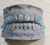 China Custom Anti-Snoring Device - Medical-Grade Thermoplastic Mandibular Advancement Device for Snoring and Sleep Apnea for sale
