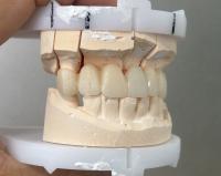 China Full Zirconia Bridge with 1200 MPa Strength High Translucency and Metal-Free for Superior Dental Restorations for sale