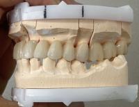 China Full Zirconia Bridge with 1200 MPa Strength High Translucency and Metal-Free for Superior Dental Restorations for sale
