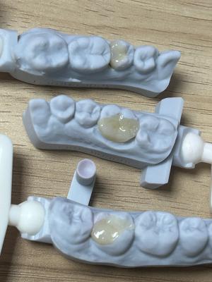 China Dental Inlay Tooth Restoration with CAD/CAM Digital Technology High Fracture Resistance and Metal-Free for sale