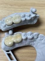 China Maryland Bridge with CAD/CAM Digital Technology for Minimally Invasive Single Tooth Replacement Using Zirconia Material for sale