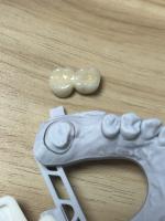 China Maryland Bridge with CAD/CAM Digital Technology for Minimally Invasive Single Tooth Replacement Using Zirconia Material for sale