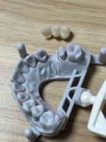 China Maryland Bridge with CAD/CAM Digital Technology for Minimally Invasive Single Tooth Replacement Using Zirconia Material for sale