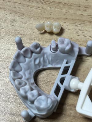 China Maryland Bridge with CAD/CAM Digital Technology for Minimally Invasive Single Tooth Replacement Using Zirconia Material for sale