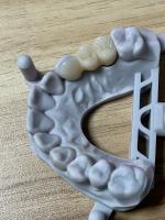 China Maryland Bridge with CAD/CAM Digital Technology for Minimally Invasive Single Tooth Replacement Using Zirconia Material for sale