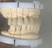 China High Translucency Full Zirconia Crown with ≥1200 MPa Strength and CAD/CAM Digital Milling for sale