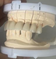 China High Translucency Full Zirconia Crown with ≥1200 MPa Strength and CAD/CAM Digital Milling for sale