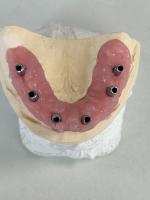 China High Strength Cobalt Chrome Implant Denture with Corrosion Resistance and Biocompatible Co-Cr Alloy for sale