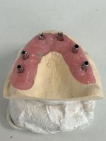 China High Strength Cobalt Chrome Implant Denture with Corrosion Resistance and Biocompatible Co-Cr Alloy for sale