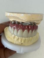 China High Strength Cobalt Chrome Implant Denture with Corrosion Resistance and Biocompatible Co-Cr Alloy for sale