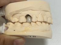 China China Dental Implant with Stable Fixation and Natural Appearance for Tooth Restoration for sale