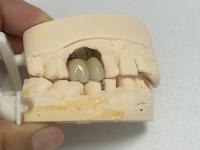 China China Dental Implant with Stable Fixation and Natural Appearance for Tooth Restoration for sale