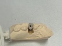 China China Dental Implant with Stable Fixation and Natural Appearance for Tooth Restoration for sale