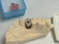 China China Dental Implant with Stable Fixation and Natural Appearance for Tooth Restoration for sale