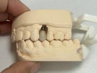 China China Dental Implant with Stable Fixation and Natural Appearance for Tooth Restoration for sale