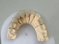 China High Strength Full Zirconia Teeth with Natural Aesthetic from ShenZhen Dental Lab for sale