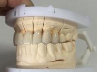 China High Strength Full Zirconia Teeth with Natural Aesthetic from ShenZhen Dental Lab for sale