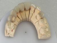 China High Strength Full Zirconia Teeth with Natural Aesthetic from ShenZhen Dental Lab for sale