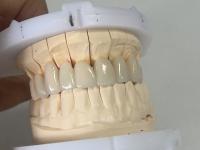 China High Strength Full Zirconia Teeth with Natural Aesthetic from ShenZhen Dental Lab for sale
