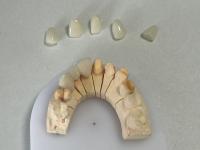 China High Strength Full Zirconia Teeth with Natural Aesthetic from ShenZhen Dental Lab for sale