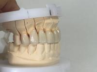 China High Strength Full Zirconia Teeth with Natural Aesthetic from ShenZhen Dental Lab for sale