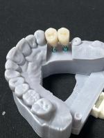 China High-Strength Zirconia Implant Restoration with Natural-Looking Appearance and Digital CAD/CAM Manufacturing for sale