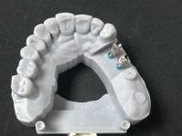 China High-Strength Zirconia Implant Restoration with Natural-Looking Appearance and Digital CAD/CAM Manufacturing for sale