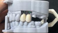 China High-Strength Zirconia Implant Restoration with Natural-Looking Appearance and Digital CAD/CAM Manufacturing for sale