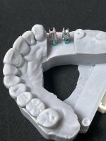 China High-Strength Zirconia Implant Restoration with Natural-Looking Appearance and Digital CAD/CAM Manufacturing for sale