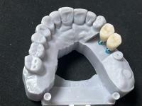 China High-Strength Zirconia Implant Restoration with Natural-Looking Appearance and Digital CAD/CAM Manufacturing for sale