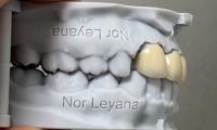 China Cobalt Chrome PFM Crown from china dental lab for sale
